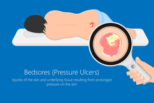 Most Common Site of Bed Sores | Pressure Sores Common Sites